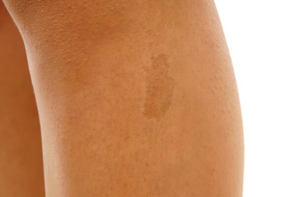 Notice a Dark Spot on Ankles or Lower Leg? It Could be a Sign of a Vein ...